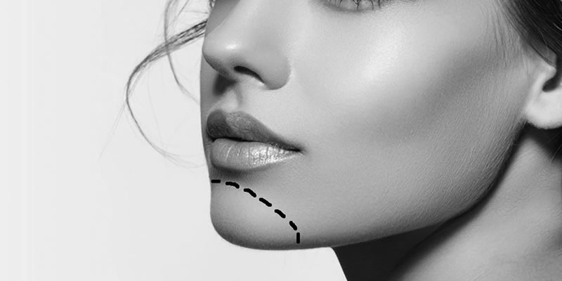 Aumento de Mentón – Dr Luis Bitar